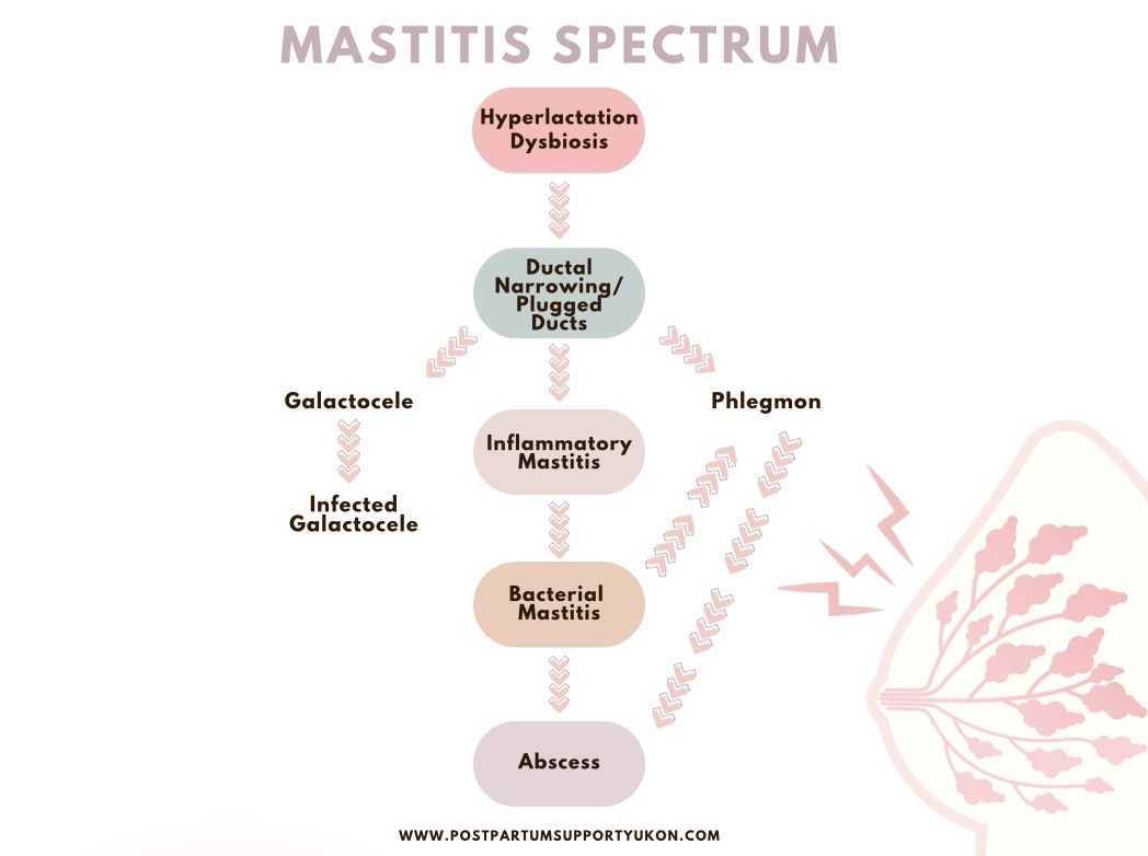 Managing Mastitis – Postpartum Support Yukon